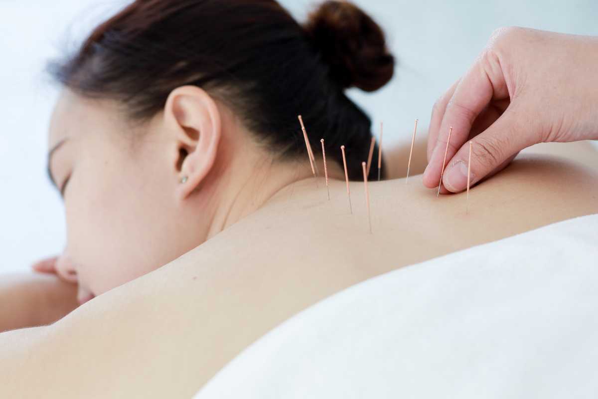 Cupping vs. Acupuncture: An In-Depth Comparison