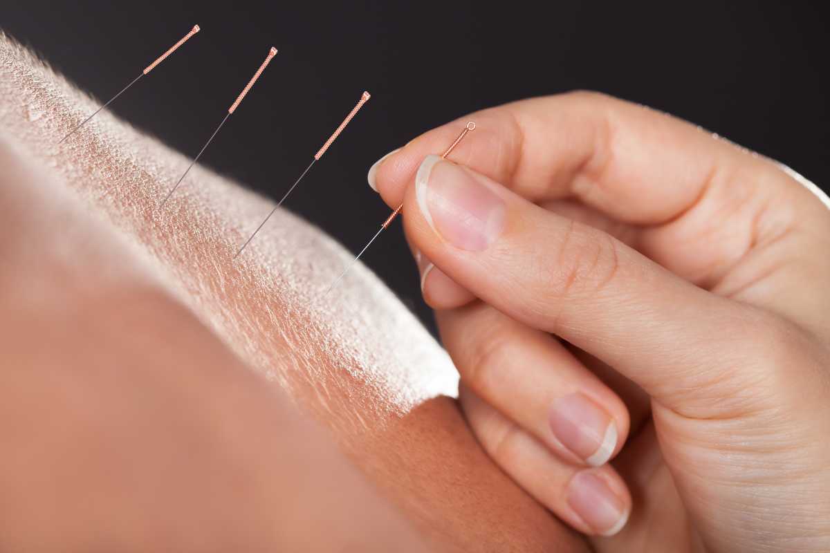 Acupuncture Trigger Points: All You Need To Know