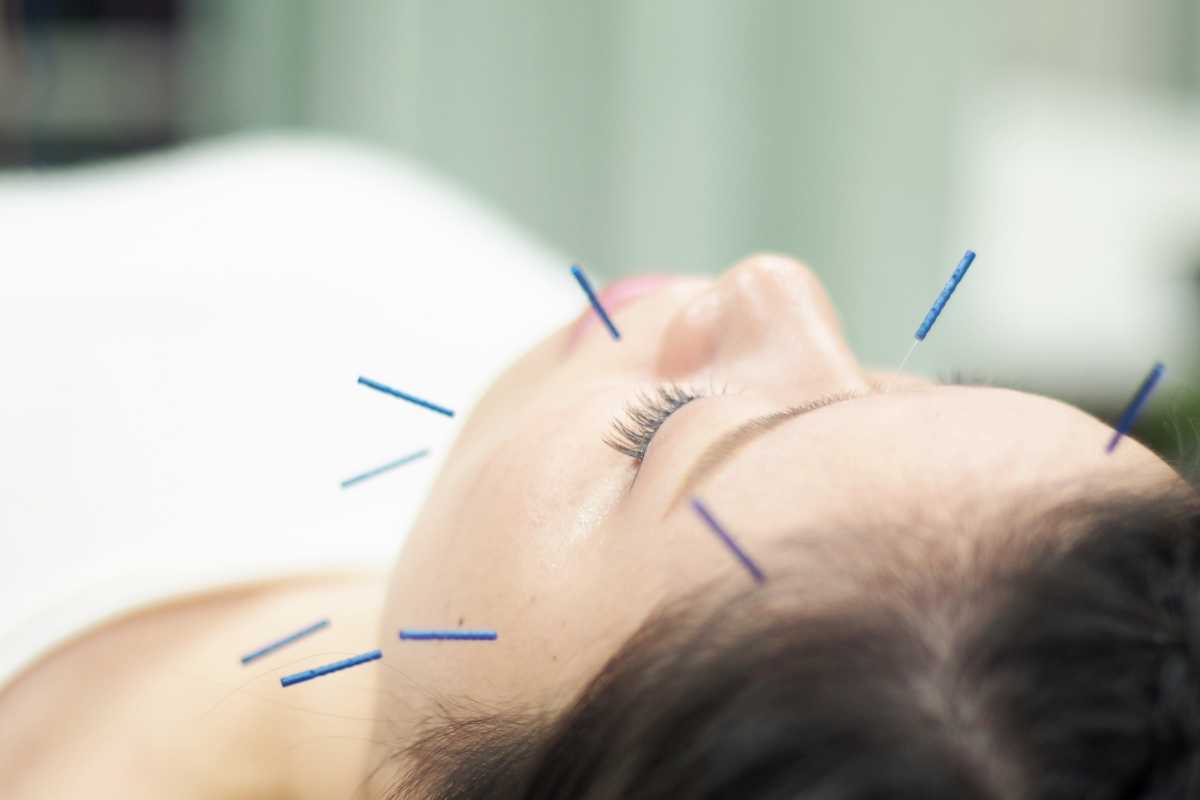 Acupuncture For Sinusitis: The Ultimate Guide