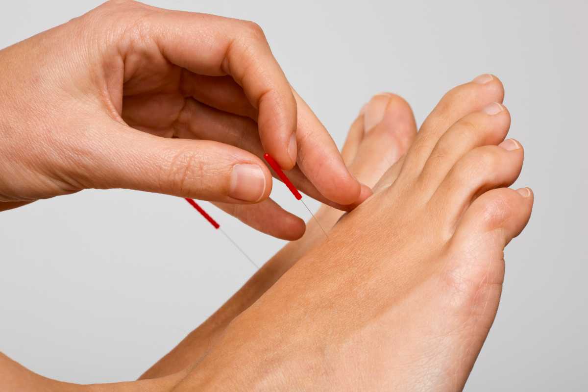 Acupuncture for Foot Pain: The Ultimate Guide