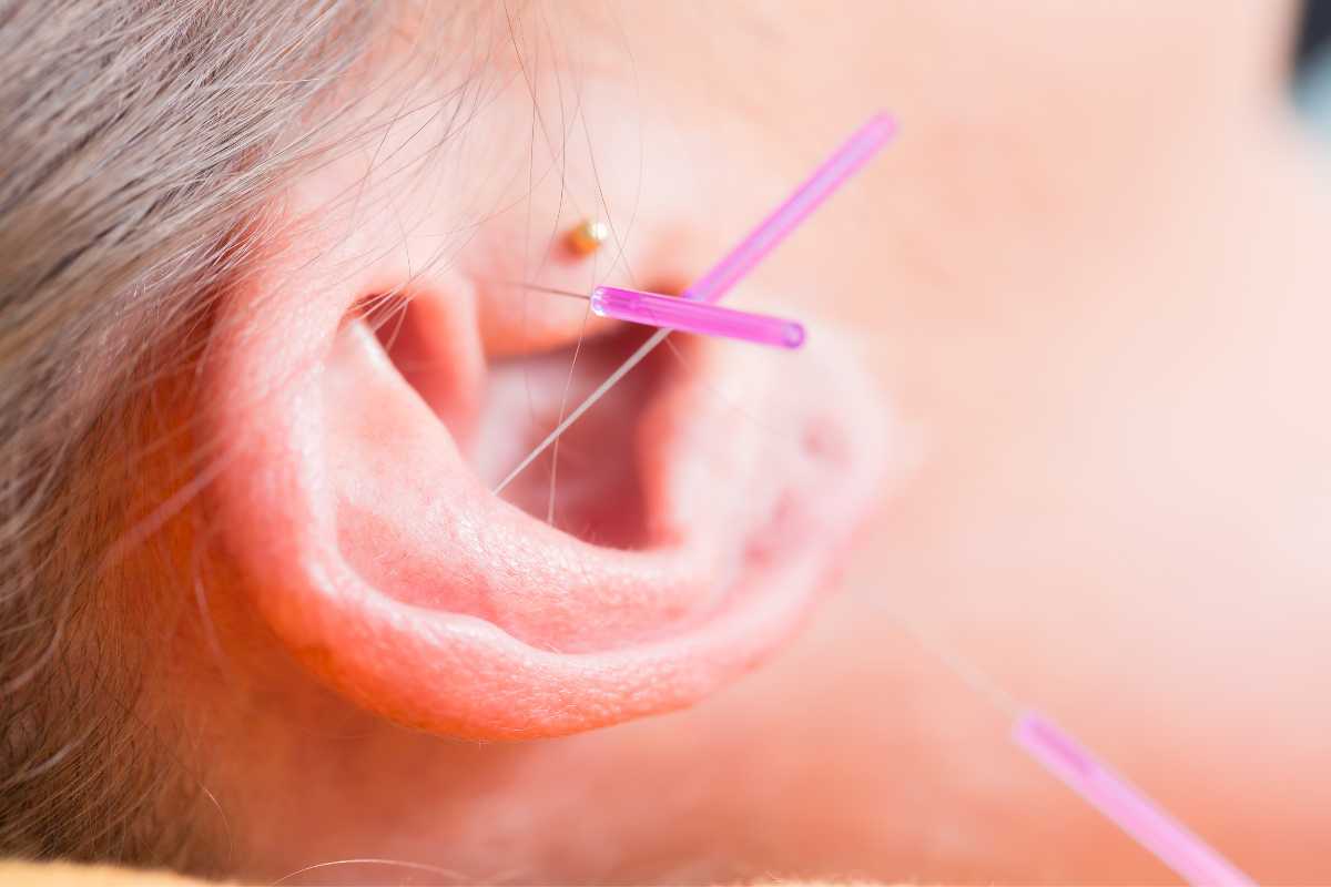 Acupuncture For Vagus Nerve Stimulation