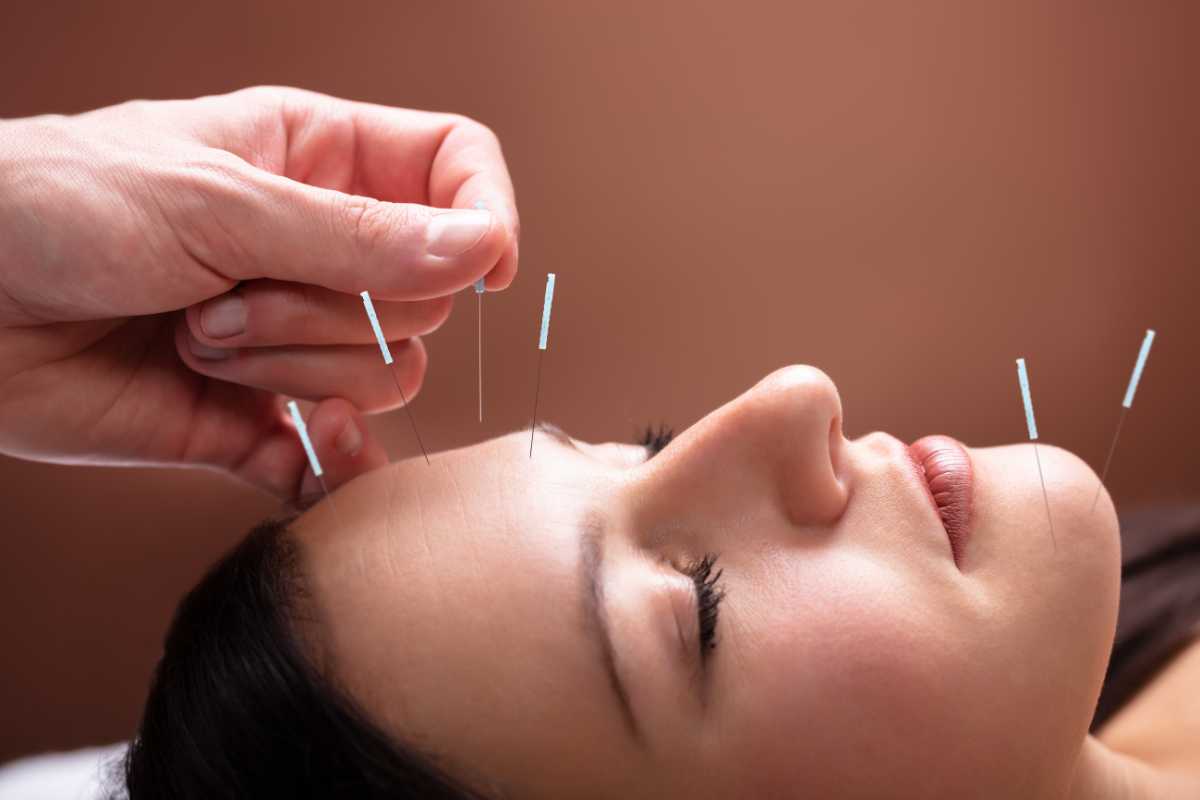 Migraine Acupuncture Effectiveness: Does Acupuncture Work