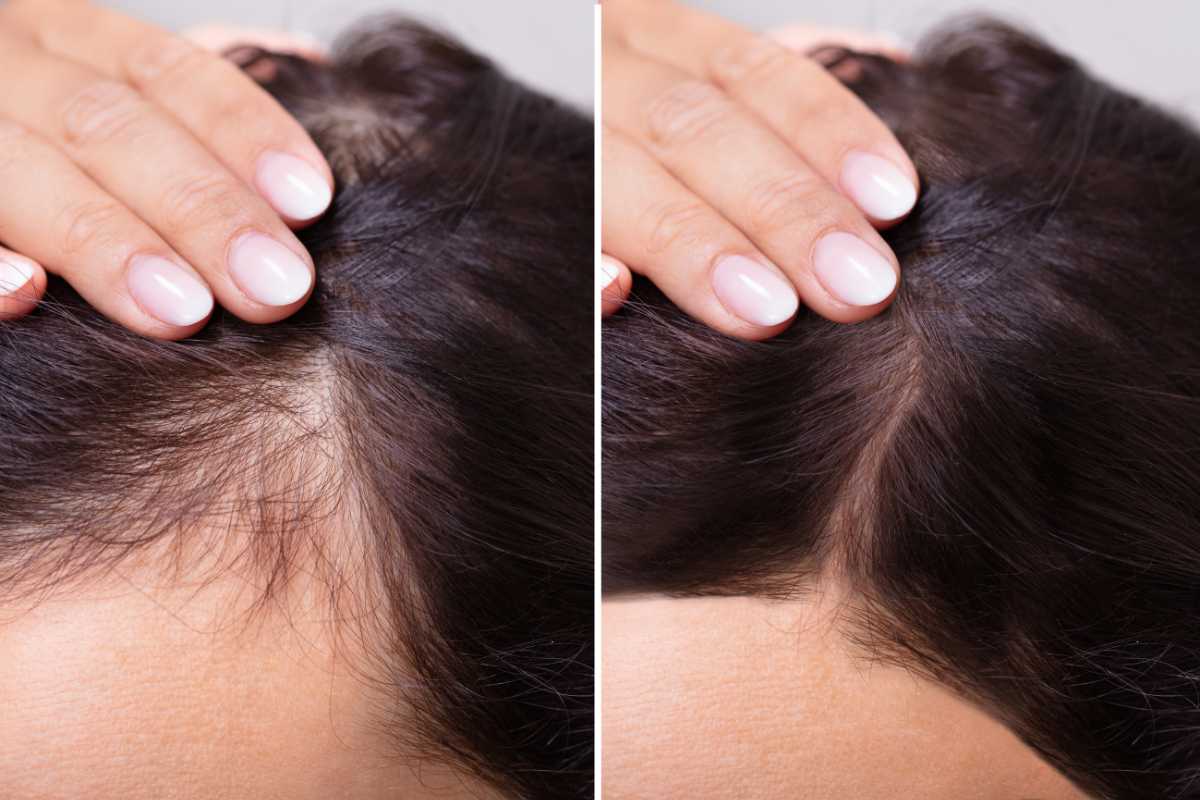 Acupuncture For Hair Loss: Does It Work?